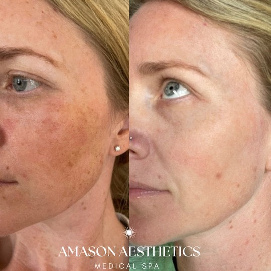 BBL- Full Face – Amason Aesthetics